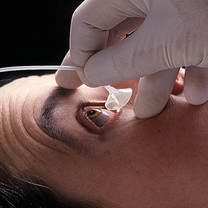 Morgan Lens - Eye Irrigation (Medi-Flow Lens) – Medisave UK