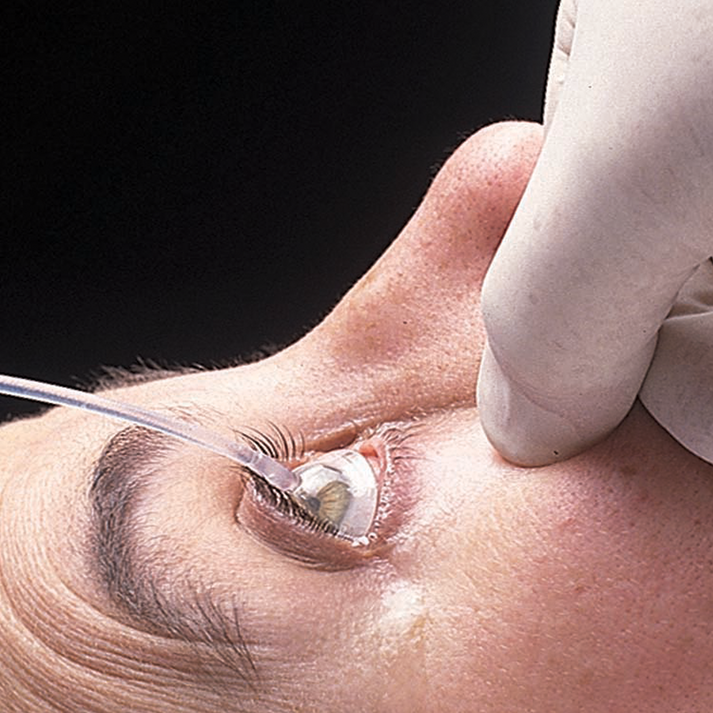 Morgan Lens - Eye Irrigation (Medi-Flow Lens) – Medisave UK