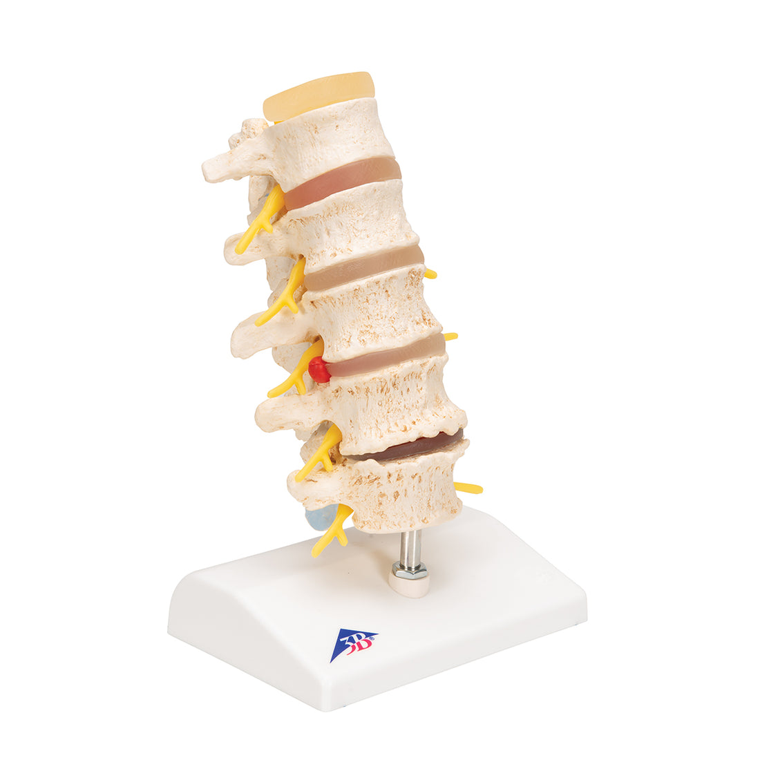 Stages of Disc Prolapse and Vertebral Degeneration – Medisave UK