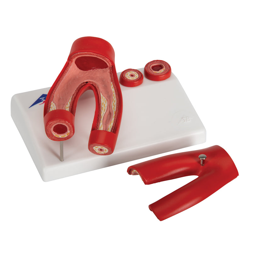 Arteriosclerosis Model, with Cross Section of Artery, 2 part – Medisave UK