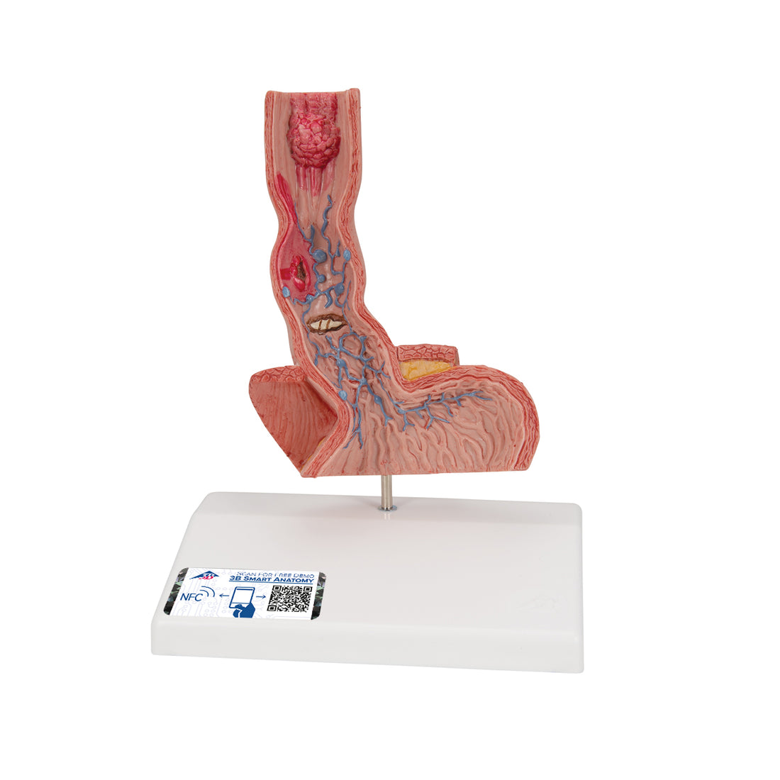 Life-Size Human Esophagus Diseases Model – Medisave UK