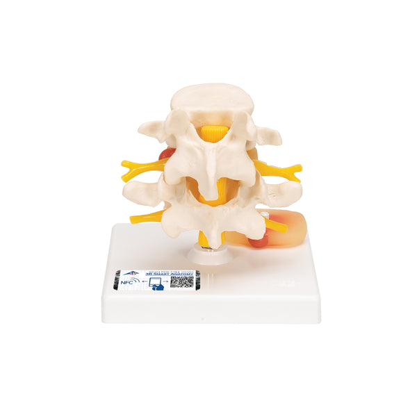 Human Lumbar Spinal Column with Prolapsed Intervertebral Disc – Medisave UK