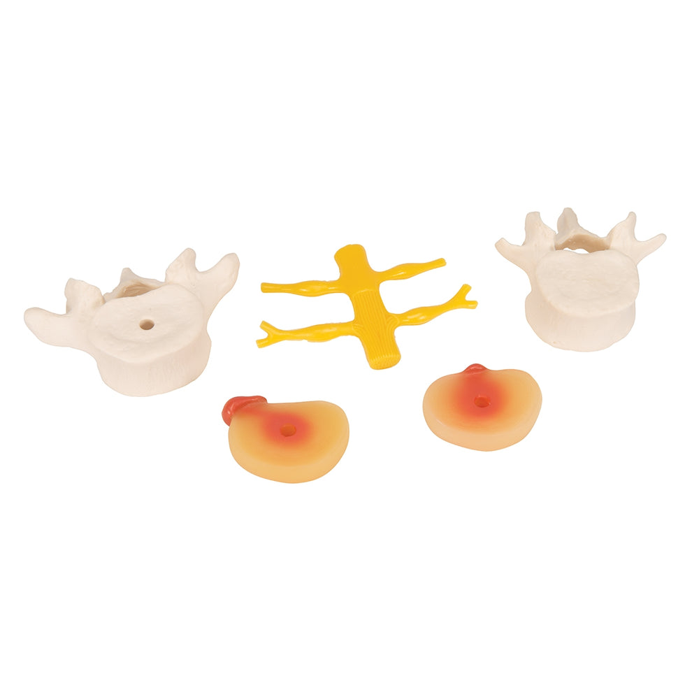 Human Lumbar Spinal Column with Prolapsed Intervertebral Disc – Medisave UK