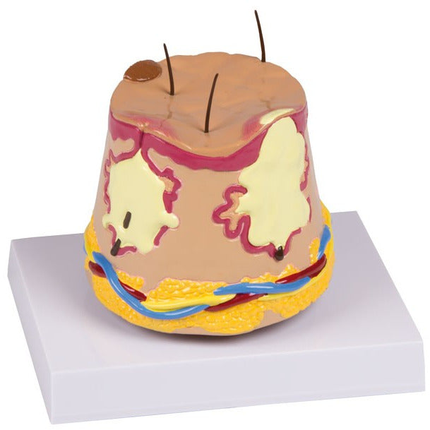 Skin Acne Model – Medisave UK