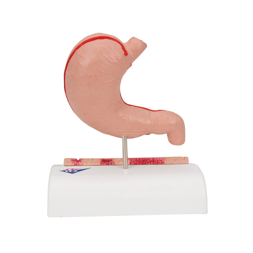 Human Stomach Section Model with Ulcers – Medisave UK