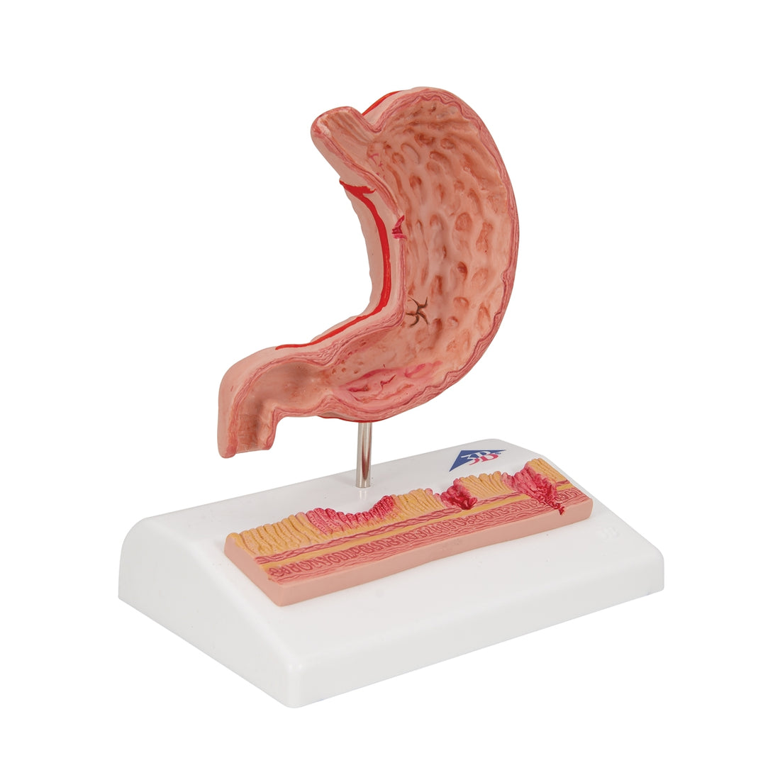 Human Stomach Section Model with Ulcers – Medisave UK