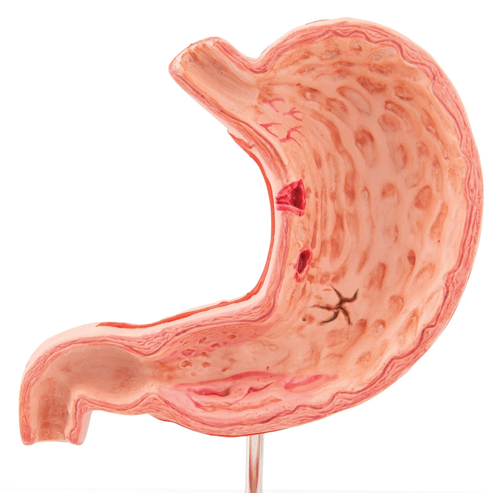 Human Stomach Section Model with Ulcers – Medisave UK