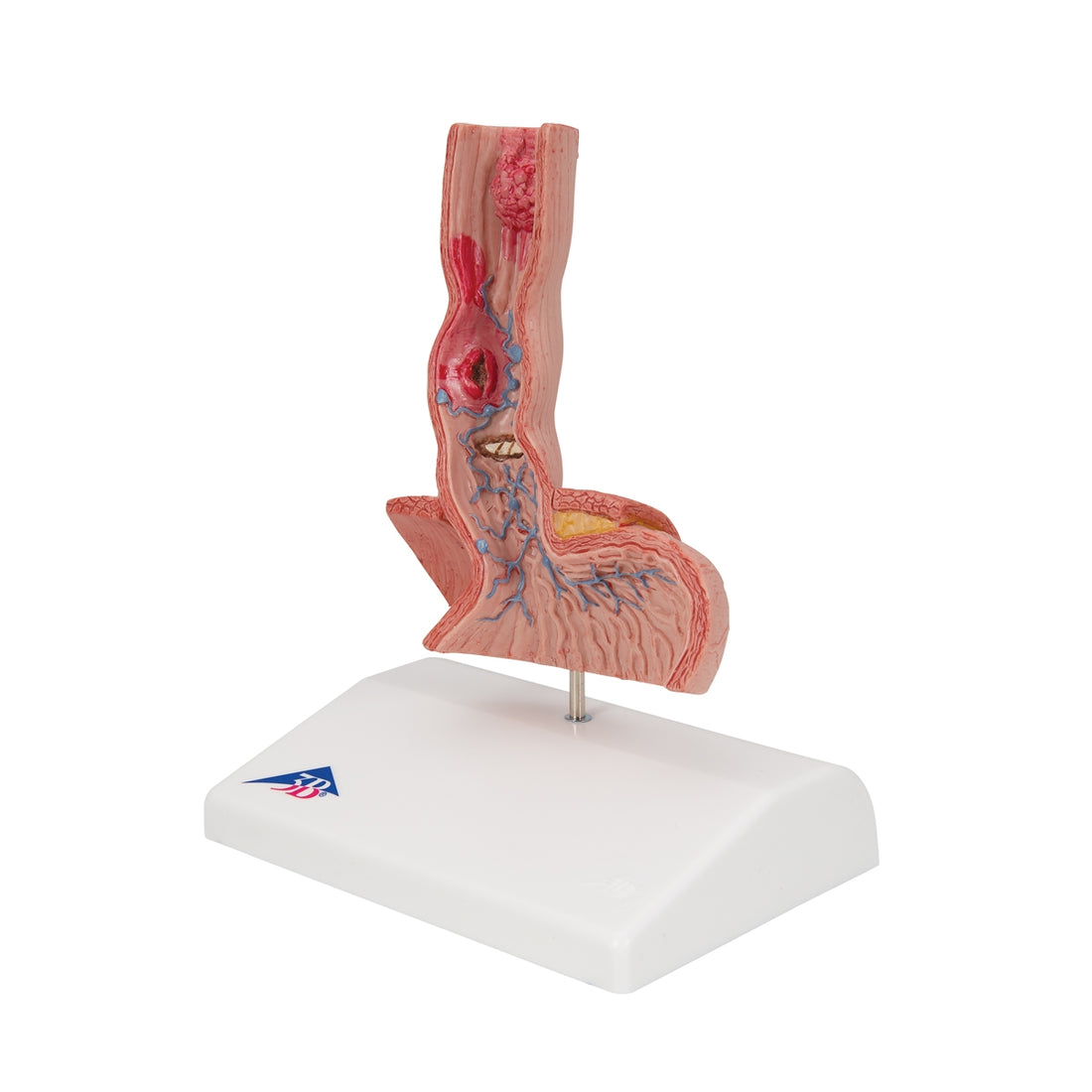 Life-Size Human Esophagus Diseases Model – Medisave UK