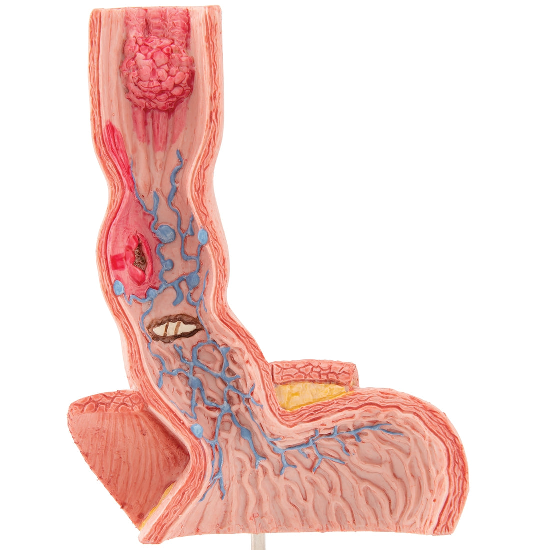 Life-Size Human Esophagus Diseases Model – Medisave UK