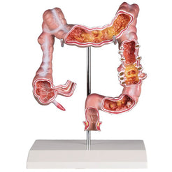 Colon Model with Diseases – Medisave UK