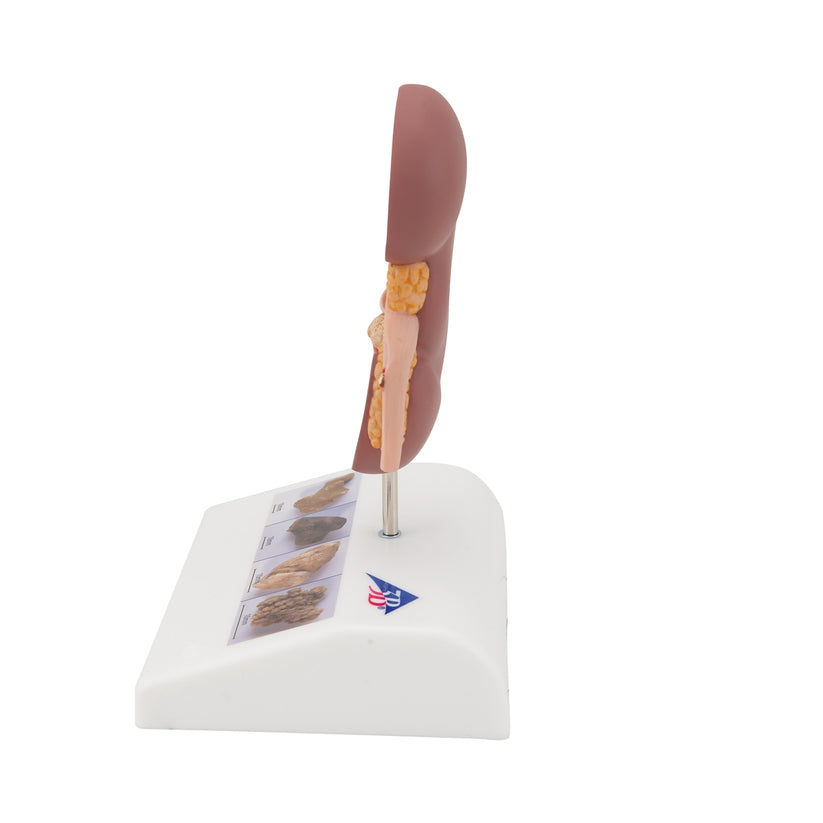 Kidney Stone Model – Medisave UK