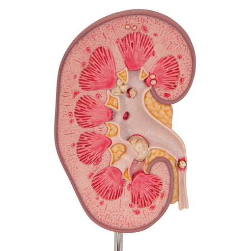 Kidney Stone Model – Medisave UK